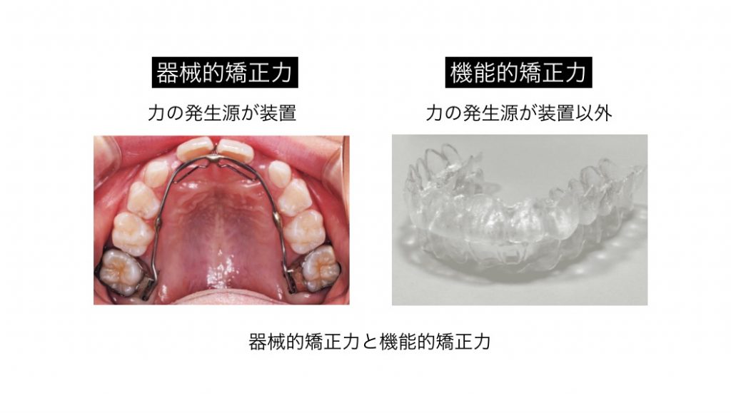 アーチレングスディスクレパンシー（ALD：Arch Length Discrepancy） - Dental Note