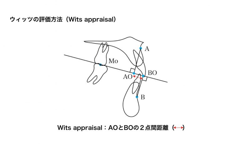 ウイッツの評価（Wits appraisal） - Dental Note